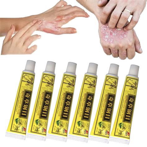 Natural Chinese Herbal Eczema Psoriasis Creams Natural Chinese Herbal