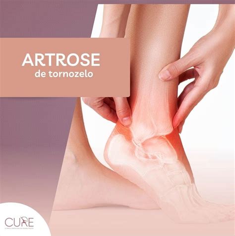 Artrose de Tornozelo Fisioterapia Clínica de Fisioterapia e Pilates