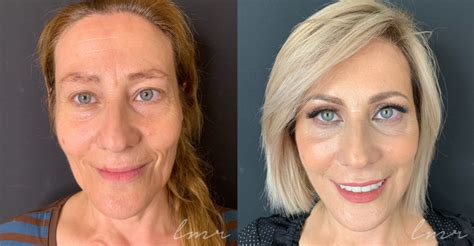 Lifting Facial Fotos Antes e Depois LMR Cirurgia Plástica