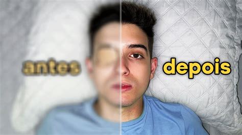 ANTES E DEPOIS Minha Cirurgia A LASER Nos Olhos YouTube