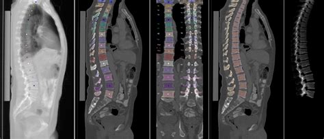 frontiers incidental vertebral fracture prediction using neuronal network based automatic