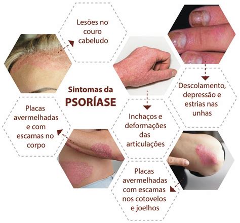 Psoríase O que é sintomas causas diagnóstico e tratamentos SBD