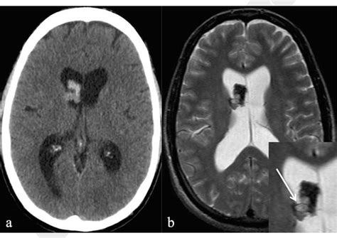 Isolated Intraventricular Haemorrhage In Adults Semantic Scholar