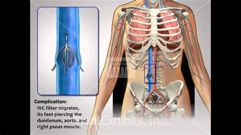 IVC Filter Complications Medical Animation YouTube