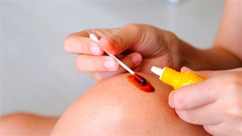 Descubre el nombre del líquido ideal para desinfectar heridas Guía