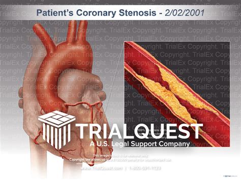 Coronary Stenosis TrialExhibits Inc