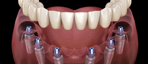 All On Dental Implants Procedure Benefits Need Cost