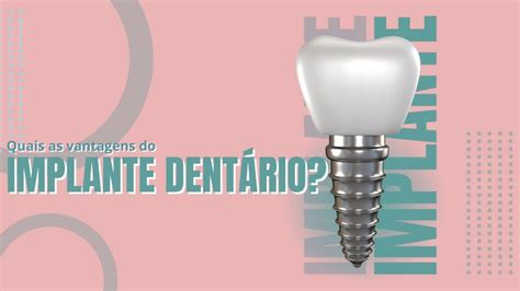 Implantes Dent Rios Por Que S O A Escolha Superior Para A Substitui O