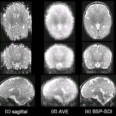 pdf robust super resolution volume reconstruction from slice acquisitions application to