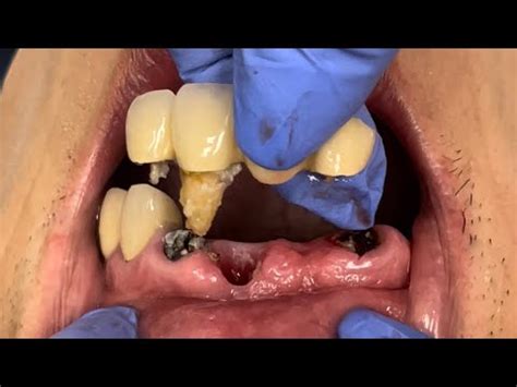 Extraction Of Hopeless Teeth Youtube
