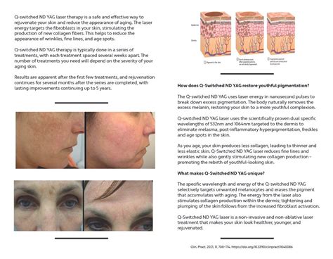 Q Switched Ruby Laser Board Certified Dermatology