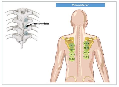 Radiofrecuencia intraarticular de las facetas torácicas Dolopedia