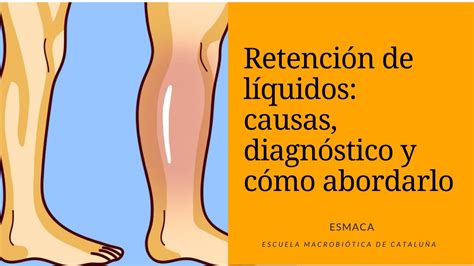Retenci N De L Quidos Causas Diagn Stico Y C Mo Abordarlo Youtube