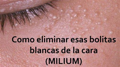 Como Quitar Los Milium De La Cara Rápido y Sencillo