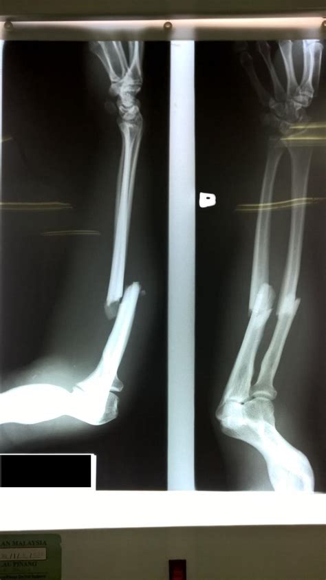 Radius And Ulnar Shaft Fractures Trauma Orthobullets