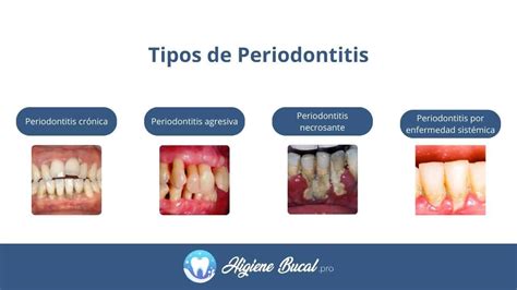 Periodontitis Qu Es Causas Tipos S Ntomas Tratamientos