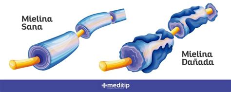 Esclerosis múltiple causas síntomas y tratamiento Meditip