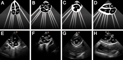 A Schematic Ilustration Of The 4 Adapted Echocardiographic Views Used