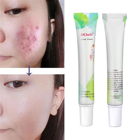 O Chelli crème d acné à base de plantes Anti boutons tache d acné