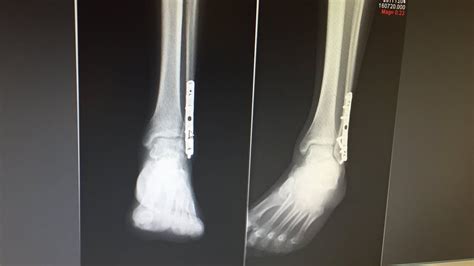 Bone Fracture Bones