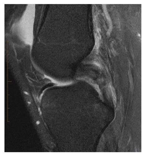 Ligamento Cruzado Posterior Lcp Dr Pedro Giglio