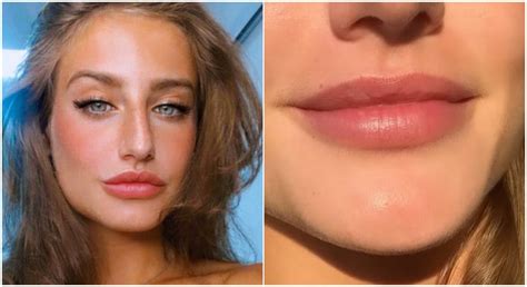 Famosos Buscam A Revers O Do Preenchimento Facial Cada Vez Mais