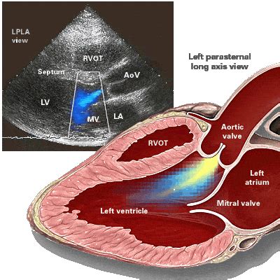 Aortic Regurgitation Symptoms Causes And Treatment Costamedic