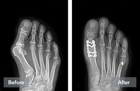 Big Toe Joint Fusion Treace