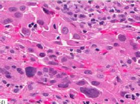 Neoplasia Flashcards Quizlet