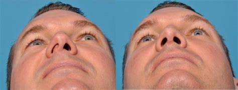 To Fix Deviated Septum Surgery