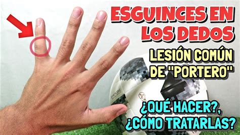 ESGUINCE EN LOS DEDOS LESIÓN DE PORTERO COMO TRATARLA Tips para