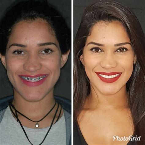 O tratamento aparelho Invisalign é mais rápido Dra Luiza Nascimento