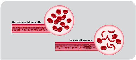 Sickle Cell Sunshine Health