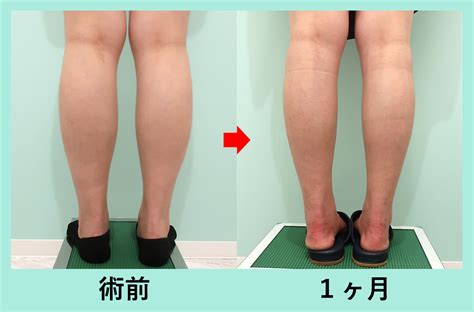 ふくらはぎ・足首をしっかり細く！ナチュラルな感じを損なわないように丁寧な吸引を心がけています 東京・銀座の美容外科クリニック｜wom Clinic Ginza