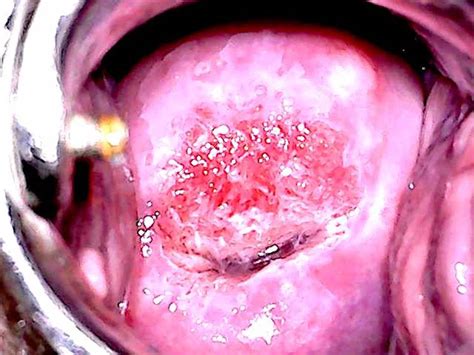 Using Human Papillomavirus HPV Detection Tests For Cervical Cancer