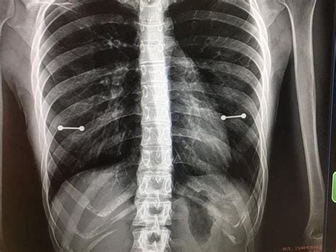 Mum Discovers Daughters Nipple Piercings After X Ray Reveals More Than Intended Shropshire Star