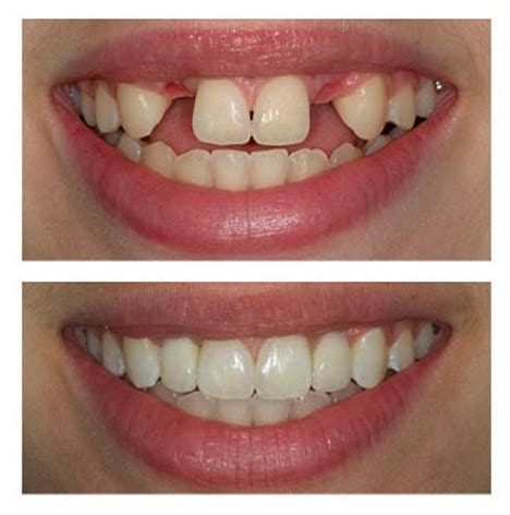 Dental Implant Before And After Photos