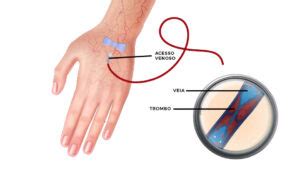 Flebite O Que Sintomas Tratamentos E Riscos Para A Sa De