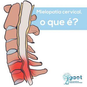 Mielopatia cervical o que é GAOT