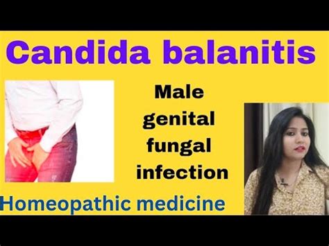 Candida Balanitis Treatment Male Genital Fungal Infection Symptoms
