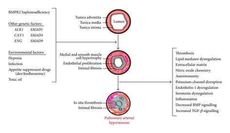 Cause And Effect In Pulmonary Arterial Hypertension Schematic