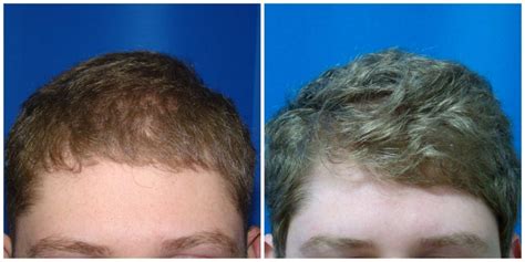 Patient Neograft Before And After Photos Houston Tx Plastic