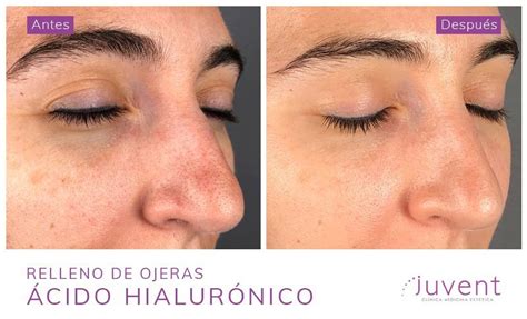 Ácido Hialurónico para eliminar las ojeras Clínica Juvent