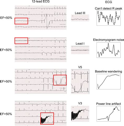 signals with excessive ecg noise such as r peak detect error download scientific diagram