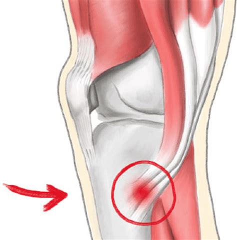 What Is Pes Anserine Bursitis Orthopedic Center For Sports Medicine