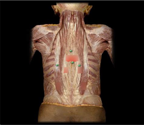 Intermediate Back Muscles Erector Spinae Diagram Quizlet