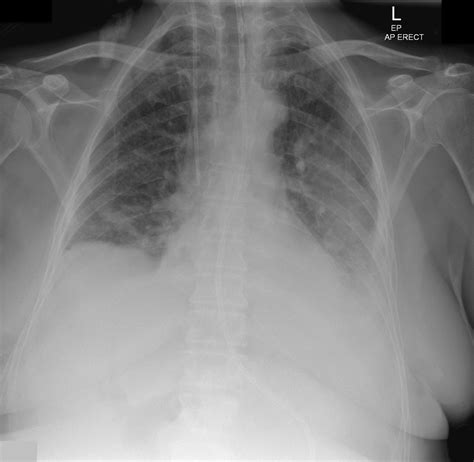 Loculated Pleural Effusion X Ray RACGP Guide To Thoracic Imaging