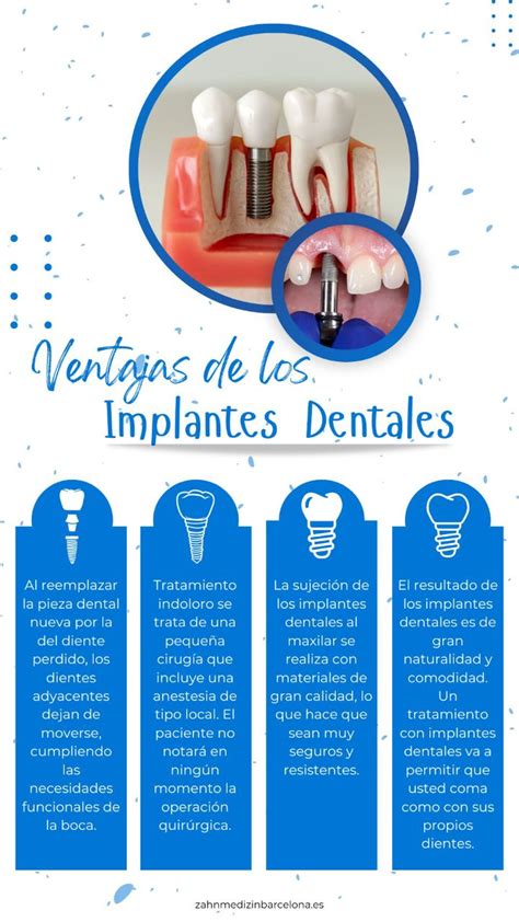 Ventajas De Los Implantes Dentales En Implantes Dentales