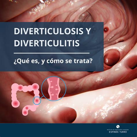 Qué es la diverticulosis y diverticulitis y cómo se trata Instituto