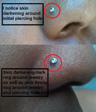 Normal Healing Process Of Nose Piercing